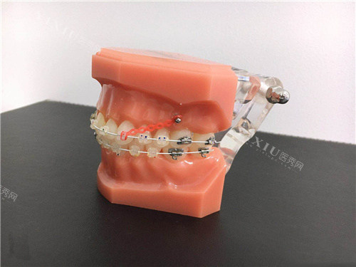 美国ormco金属自锁托槽费用揭秘，堪称性价比之选正畸不贵！-医秀网